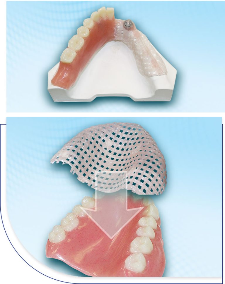 FiBER FORCE® - Dental Supplies - Synca
